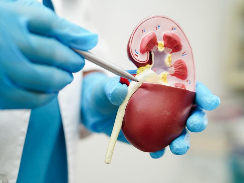 Cirurgia de Cálculo Renal em Curitiba - Dr. Matheus Pupulin